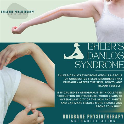 Ehlers Danlos Syndrome And How A Physiotherapist Can Help Brisbane