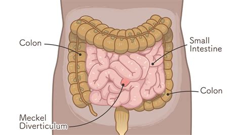 Meckels Diverticulum Symptoms Risks And Treatments Los Angeles Times