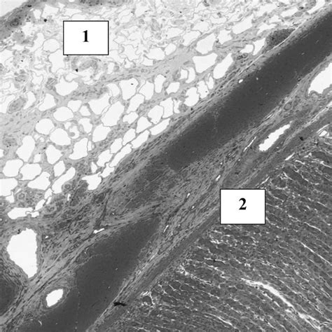 Drawing Of Graham Omentoplasty A Suture Runs Through The Gastric Wall