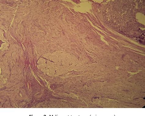 Figure 1 From Abscessed Inguinal Metastasis Of Testicular Tumor Case