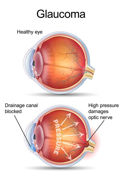 Merrillville IN Selective Laser Trabeculoplasty SLT For Glaucoma