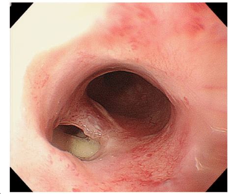Endoscopy Revealed An Esophageal Perforation In The Left Side Of The
