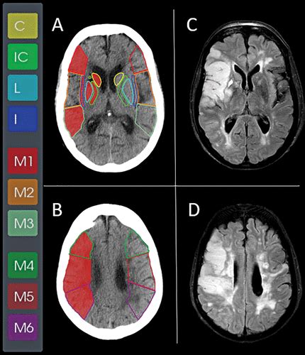 Aspects Alberta Stroke Program Early Ct Score Measurement 51 Off