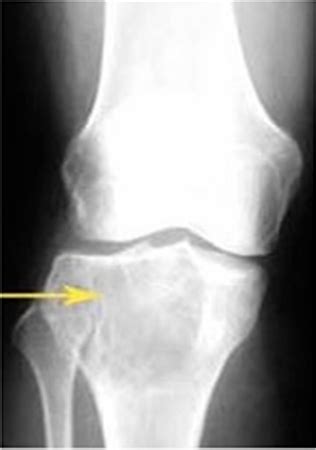 Giant Cell Tumor Pathology Orthobullets