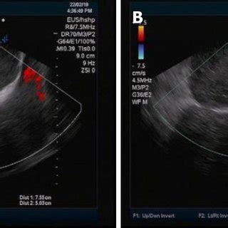 Endoscopic Ultrasound Images Of The Patient A Endoscopic Ultrasound Download Scientific
