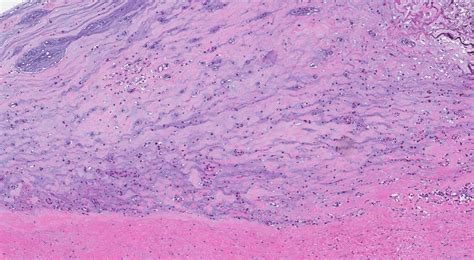 Cardiac Myxoma Atlas Of Pathology