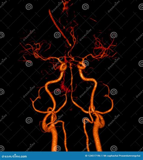 Cta Brain Or Ct Angiography Of The Brain 3d Rendering Image Ap And Lateral View Showing Cerebral