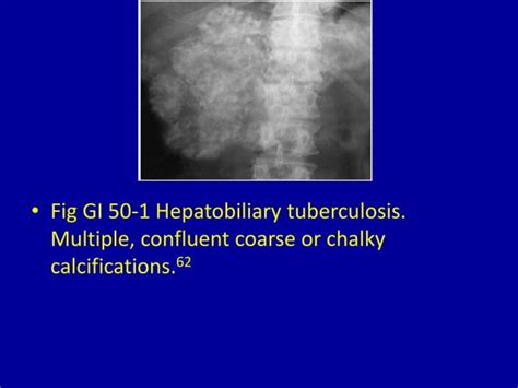 Liver Calcification Pptx