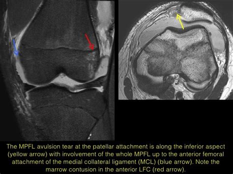 Mri Of Patellar Disorders