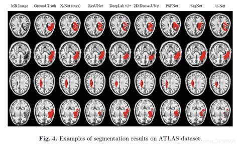 医学图像分割 （miccai 2019）selective Feature Aggregation Network With Area Bo