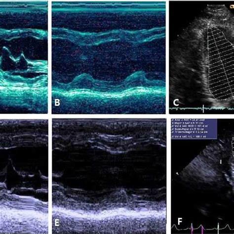 Echocardiography Was Showed That Increased Dimension And Volume Of Lv Download Scientific