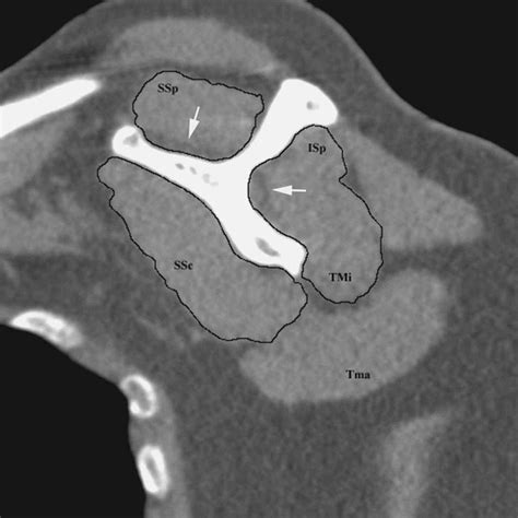 PDF Subacromial Space Measurement