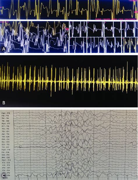 Electromyogram Showing Motor Unit Action Potentials Of Large Amplitude Download Scientific