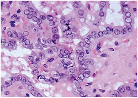 Figure 2 From Mandibular Metastasis Revealed Papillary Thyroid
