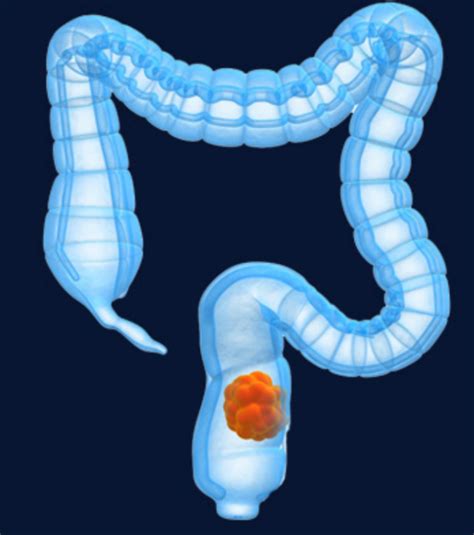 Рак толстой кишки у женщин фото