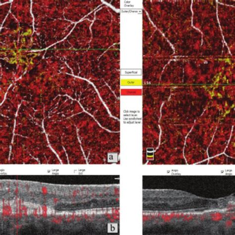 Patient 1 Right Eye A Superficial Capillary Plexus Appears Normal On