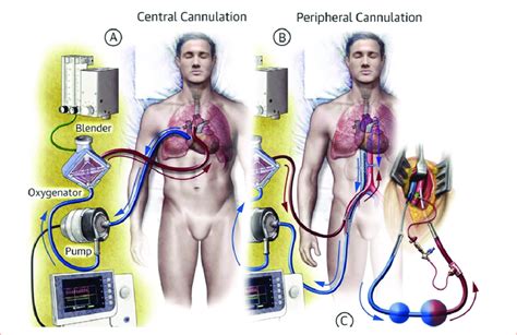 Canulación Básica Para Ecmo Veno Arterial A Canulación Central B