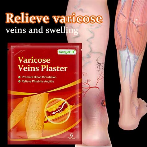 Varicose Veins Patch Varicose Veins Ointmnet Vasculitis Phlebitis