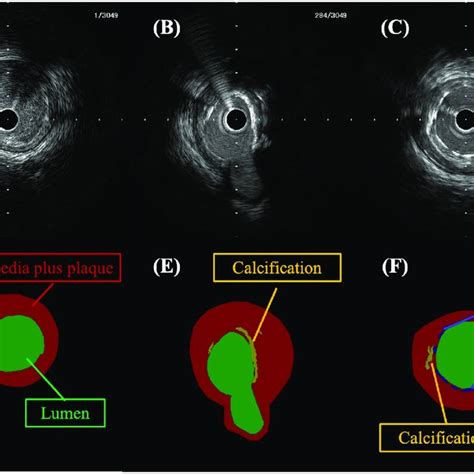 Representative Manually Segmented Ivus Images And Mask Images Upper