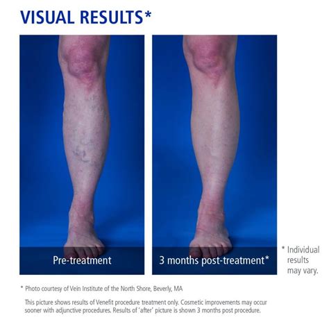 Endovenous Ablation Phoenix AZ Maricopa AZ Affiliated
