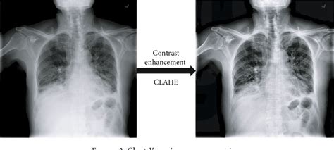 figure 1 from pneumonia detection using an improved algorithm based on