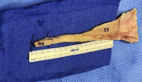 Picture Of An Achilles Allograft With A Bone Block Showing A Long Graft