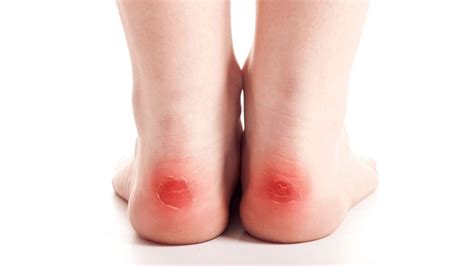 A Blister On My Foot Online