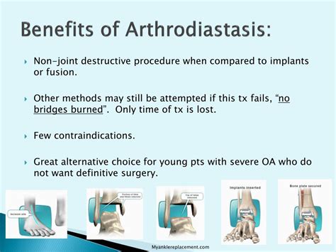 Ppt Arthrodiastasis Of The Ankle Joint Dan Preece Ms Iv Cspm Class