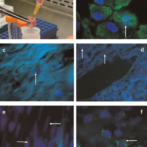 Male Fetal Microchimerism In Female Marrow Bone Lung And Appendix A