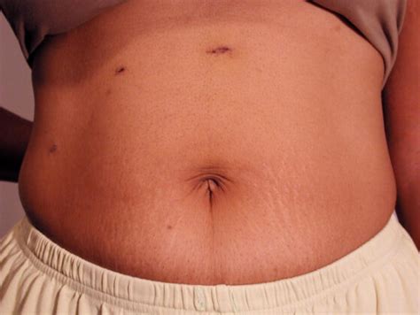 Laparoscopic Cholecystectomy Cpt Code Understanding The Surgical