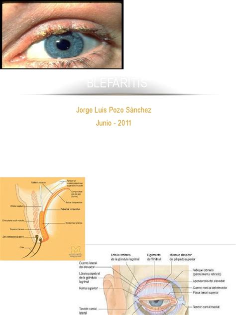 Blefaritis Pdf Especialidades Medicas Enfermedades Y Trastornos