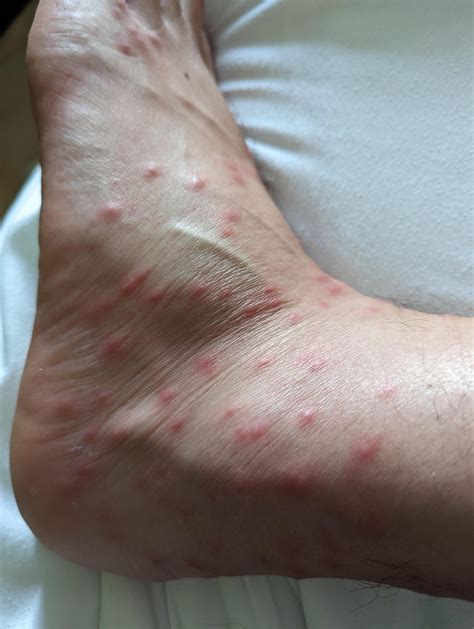 Bed Bug Bites Vs Mosquito Bites