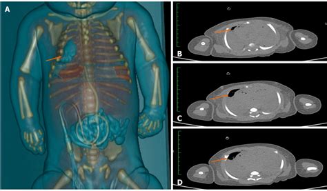 results of imaging examination a total body postmortem computed