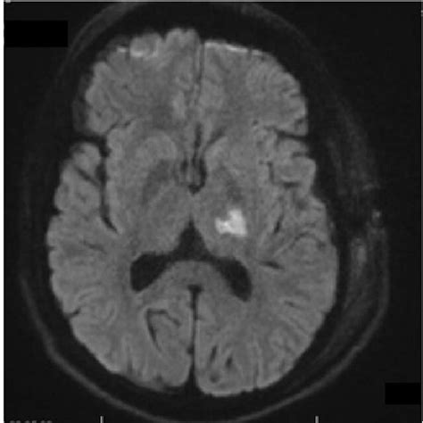 Axial Diffusion Weighted Mri Shows Restricted Diffusion In The