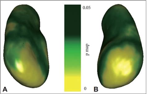 Changes In The Hippocampal Volume And Shape In Early Onset Mild Cognitive Impairment Abstract