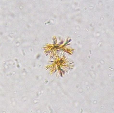 Bilirubin Crystal In Urine