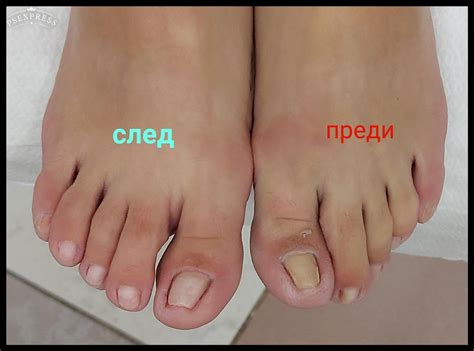 Красиви нокти! Медицински педикюр с лак, гел лак или избелваща ...