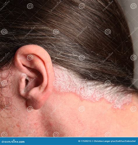 Psoriasis In The Ear And Neck Stock Image Image Of Finger Relief 17539215