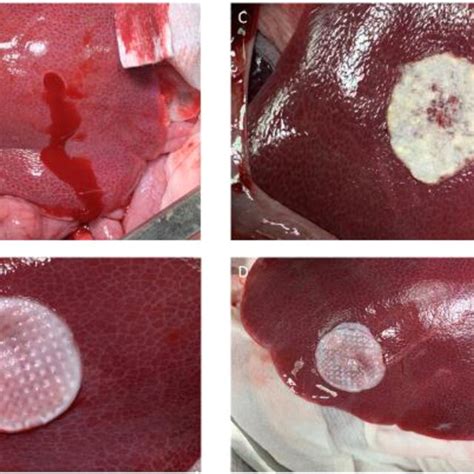 Bleeding Scale And Comparison Of Bleedings Between Groups Before