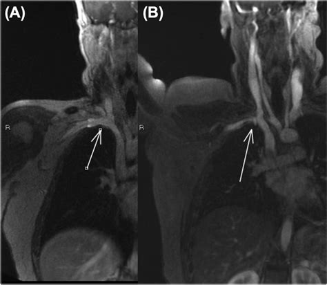 Translated Article Unilateral Hyperhidrosis Symptom Of Thoracic
