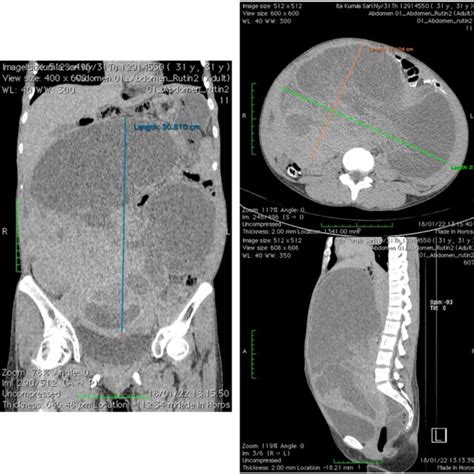 Imaging Ct Scan Abdomen Pelvic With Contrast Pre Operation First