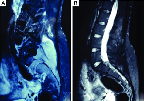 Sagittal T2 Weighted Lumbar Magnetic Resonance Imaging Mri Of Mass