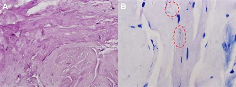 A Core Biopsy Of The Right Femoral Head Revealed Necrotic Material