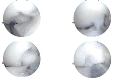 Knee Arthroscopy Chondroplasty And Medial Meniscectomy