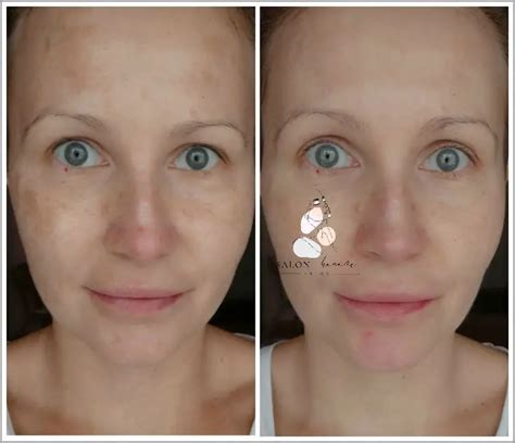 Retinol Przed I Po Zobacz Zaskakujące Efekty Zaktualizowano maj Salonhanami pl