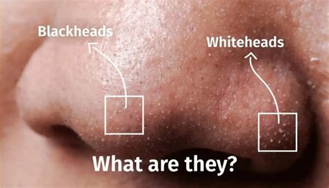 The Causes Of Whiteheads Key Insights You Need