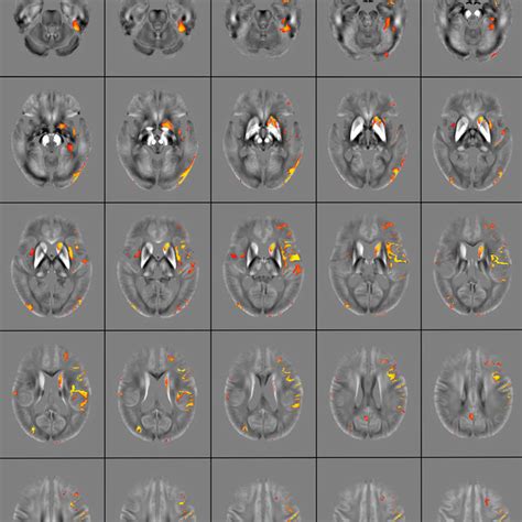 Results From Whole Brain Absolute Qsm Analysis Red Yellow Clusters