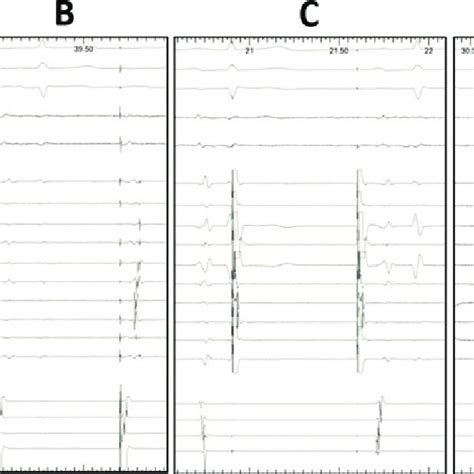 Recording From A Circular Mapping Catheter Showing Overlap Of Far Field Download Scientific