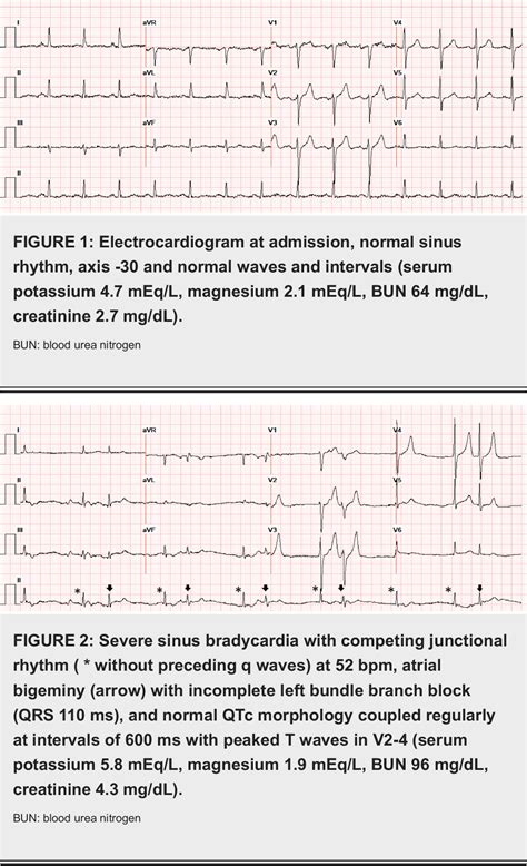 Junctional Rhythm