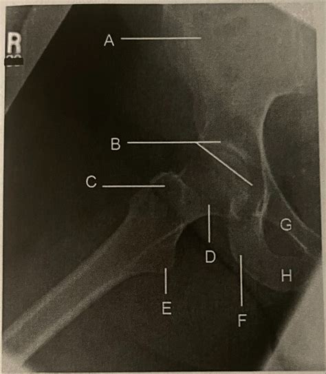Ap Hip Xray Diagram Quizlet